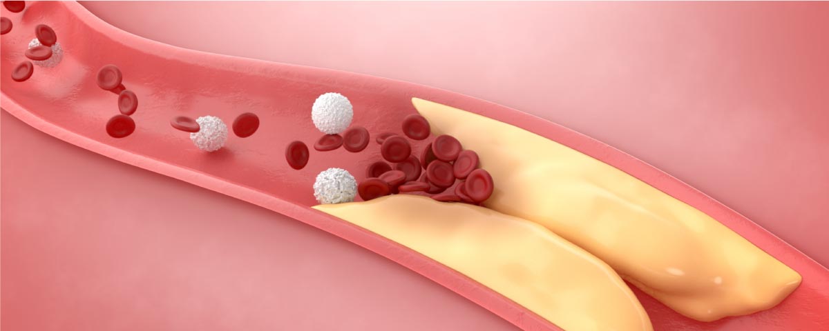 Myocardial Infarction Types Symptoms And Causes Truebasics Blog